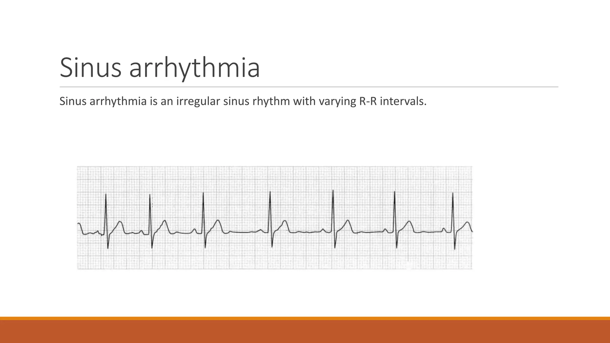 Abnormal ECG- Arhythmia.pptx