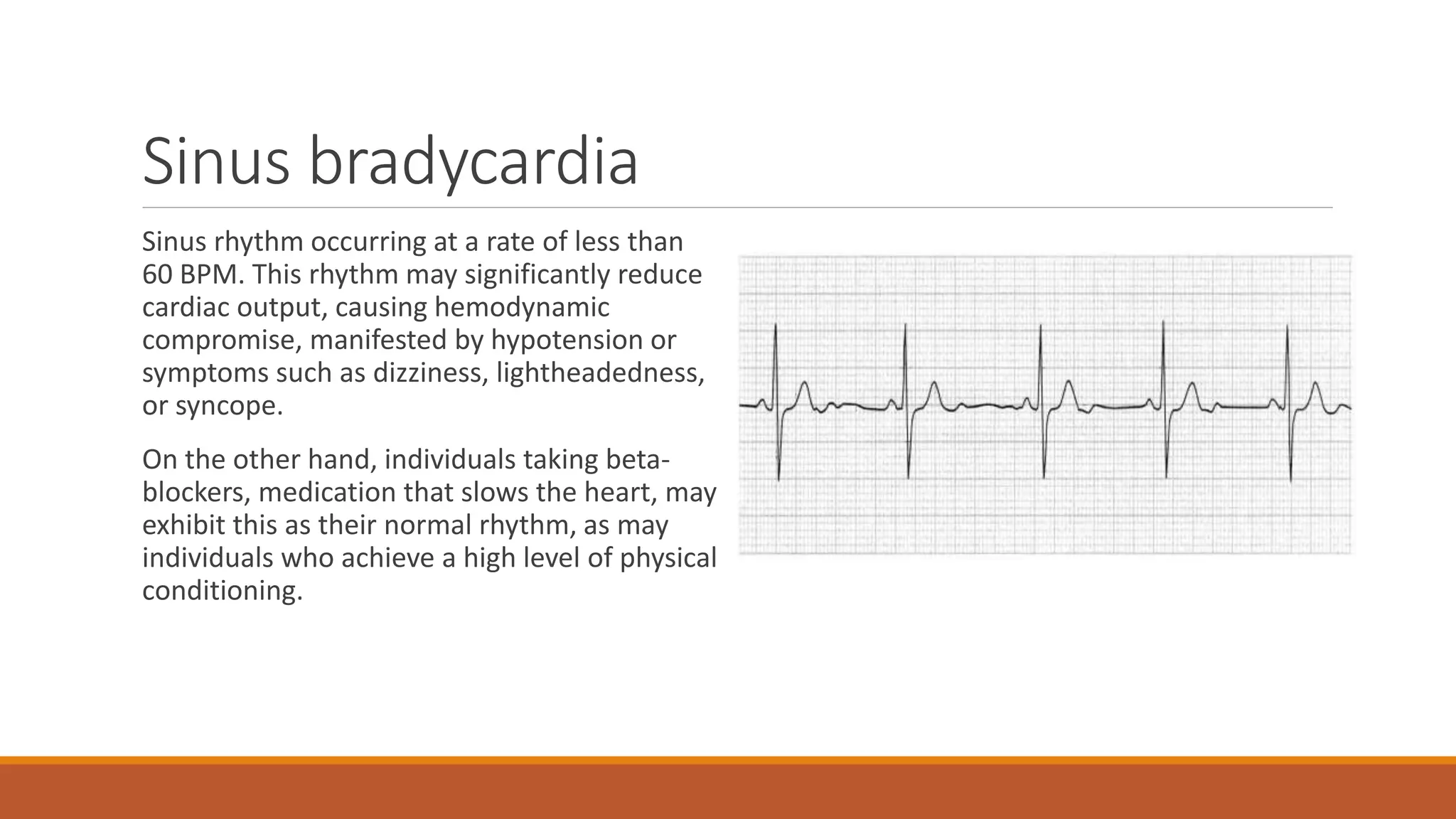 Abnormal ECG- Arhythmia.pptx