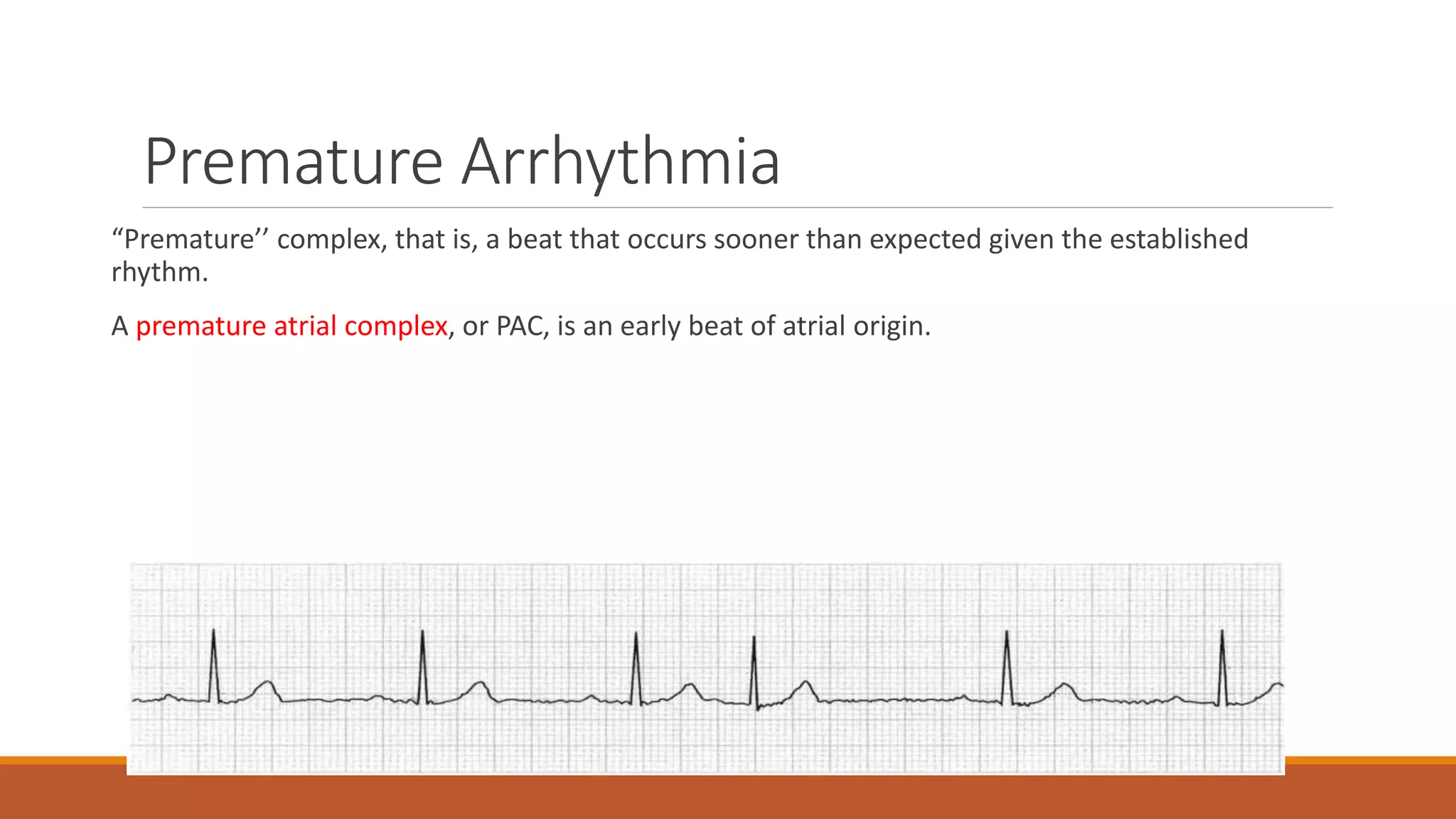 Abnormal ECG- Arhythmia.pptx