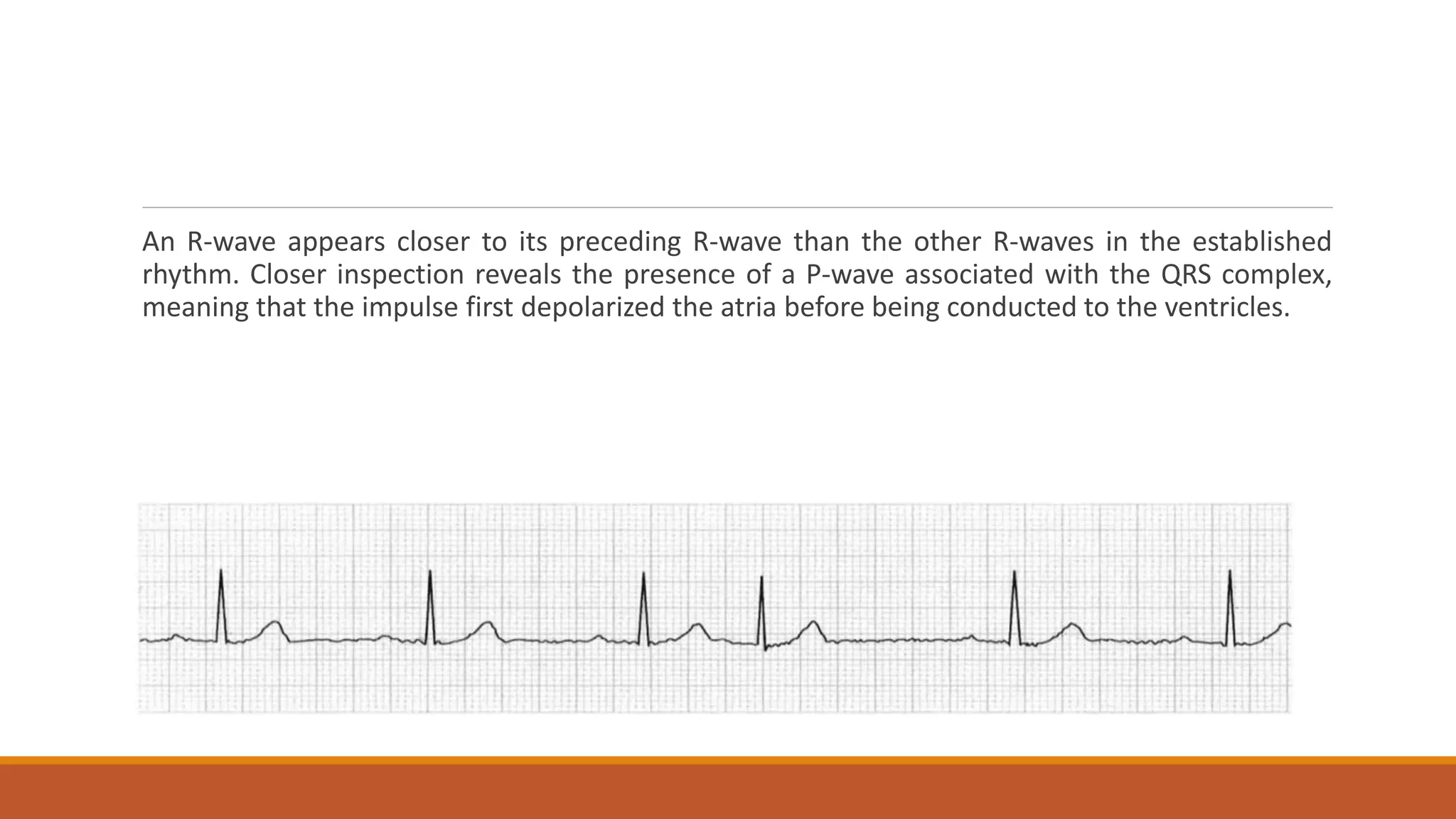 Abnormal ECG- Arhythmia.pptx