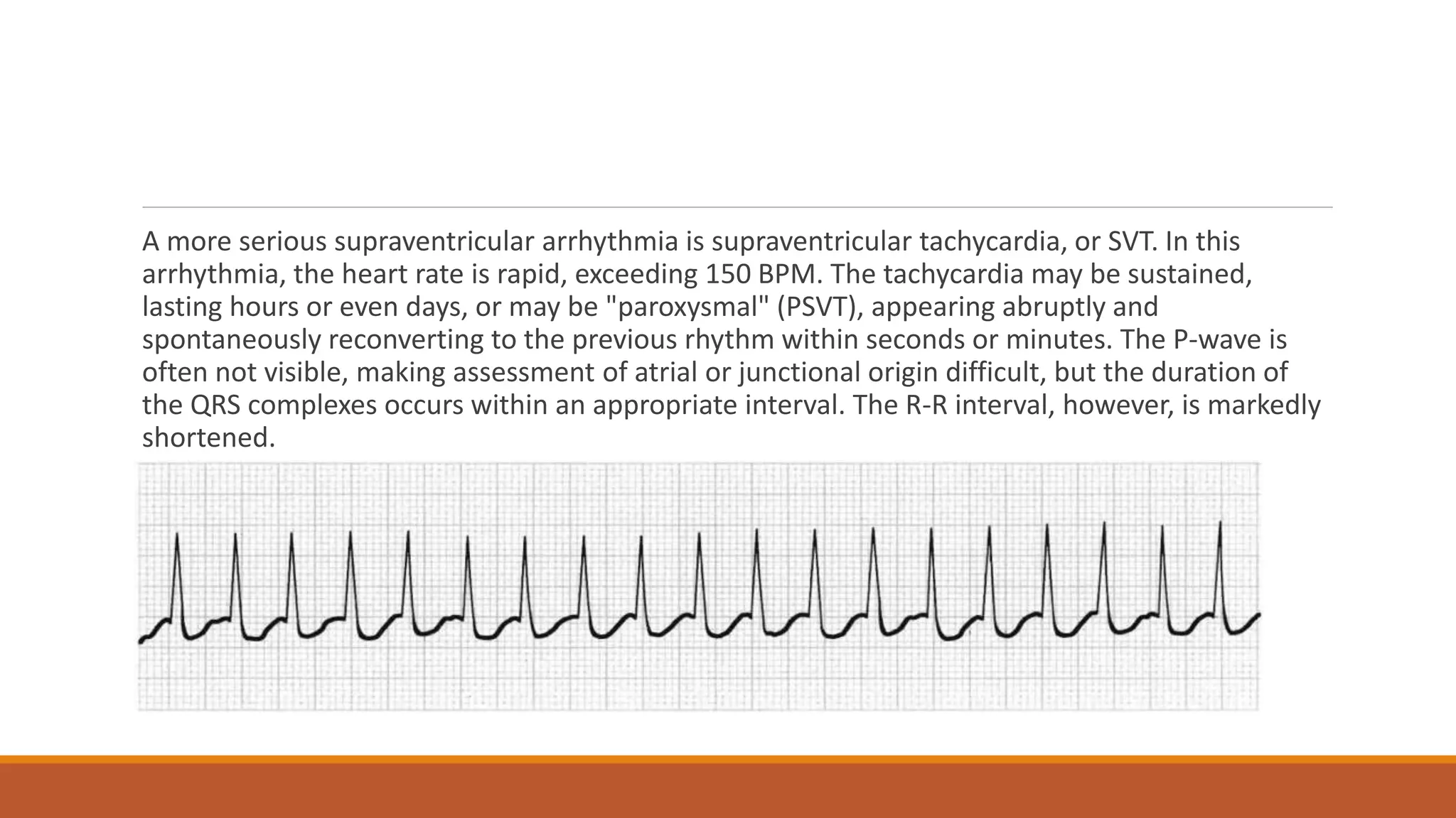 Abnormal ECG- Arhythmia.pptx