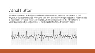 Abnormal ECG- Arhythmia.pptx