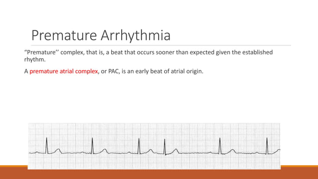 Abnormal ECG- Arhythmia.pptx