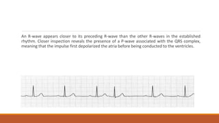 Abnormal ECG- Arhythmia.pptx