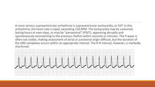 Abnormal ECG- Arhythmia.pptx