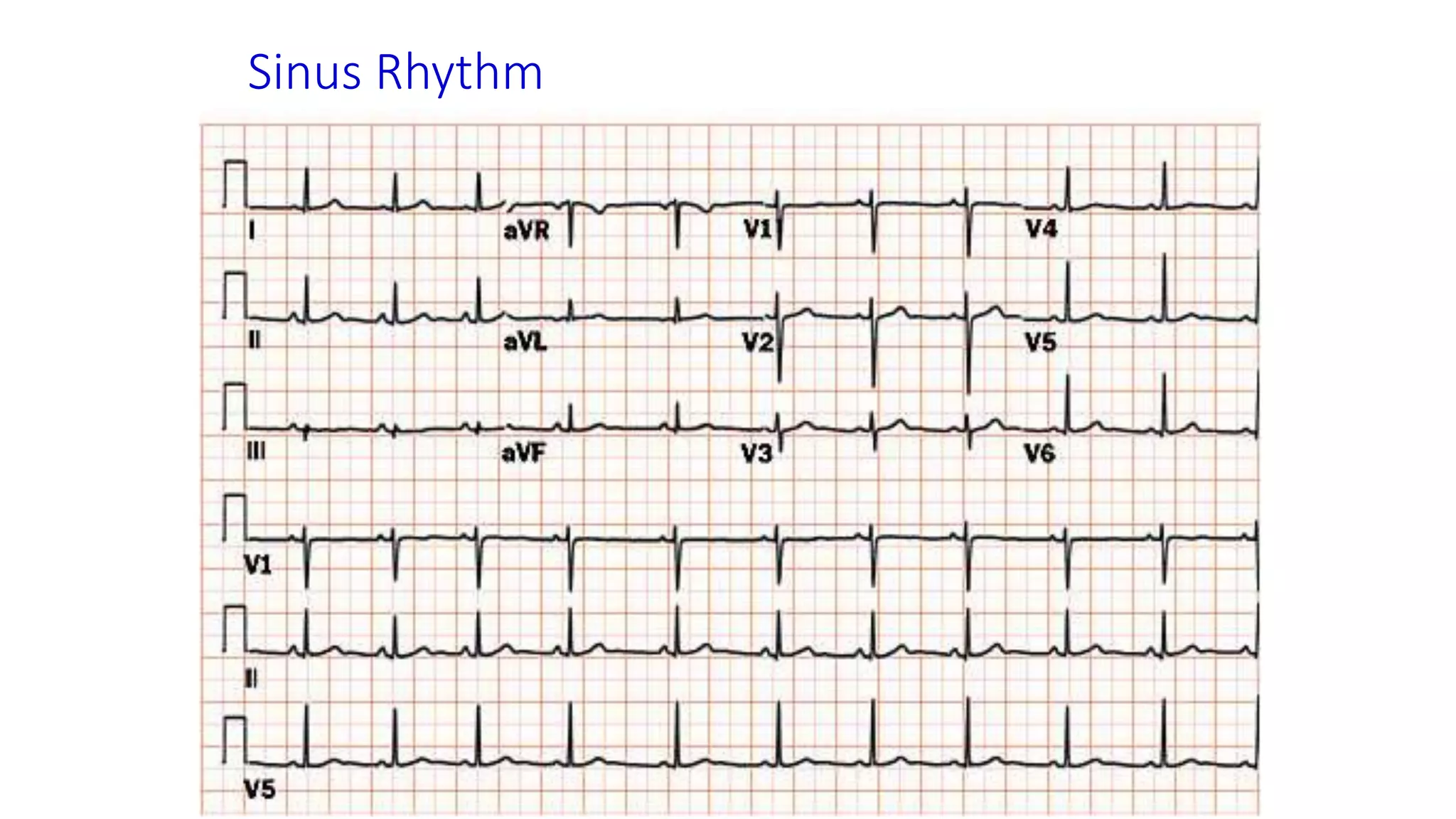 abnormal ECG in normal patients - Dr Vijan.pptx