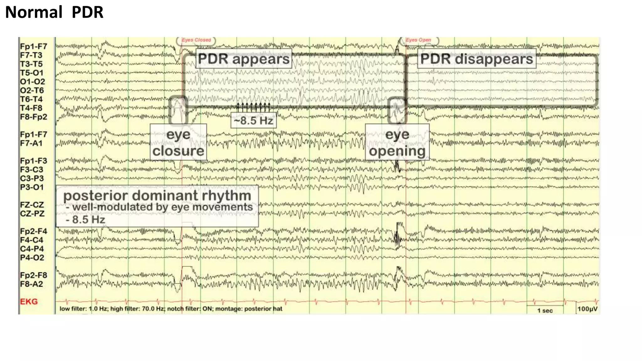 Abnormal eeg | PPTX