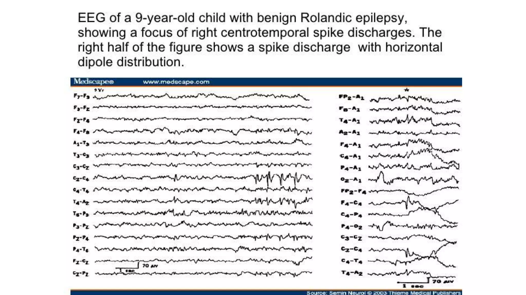 Abnormal eeg | PPTX