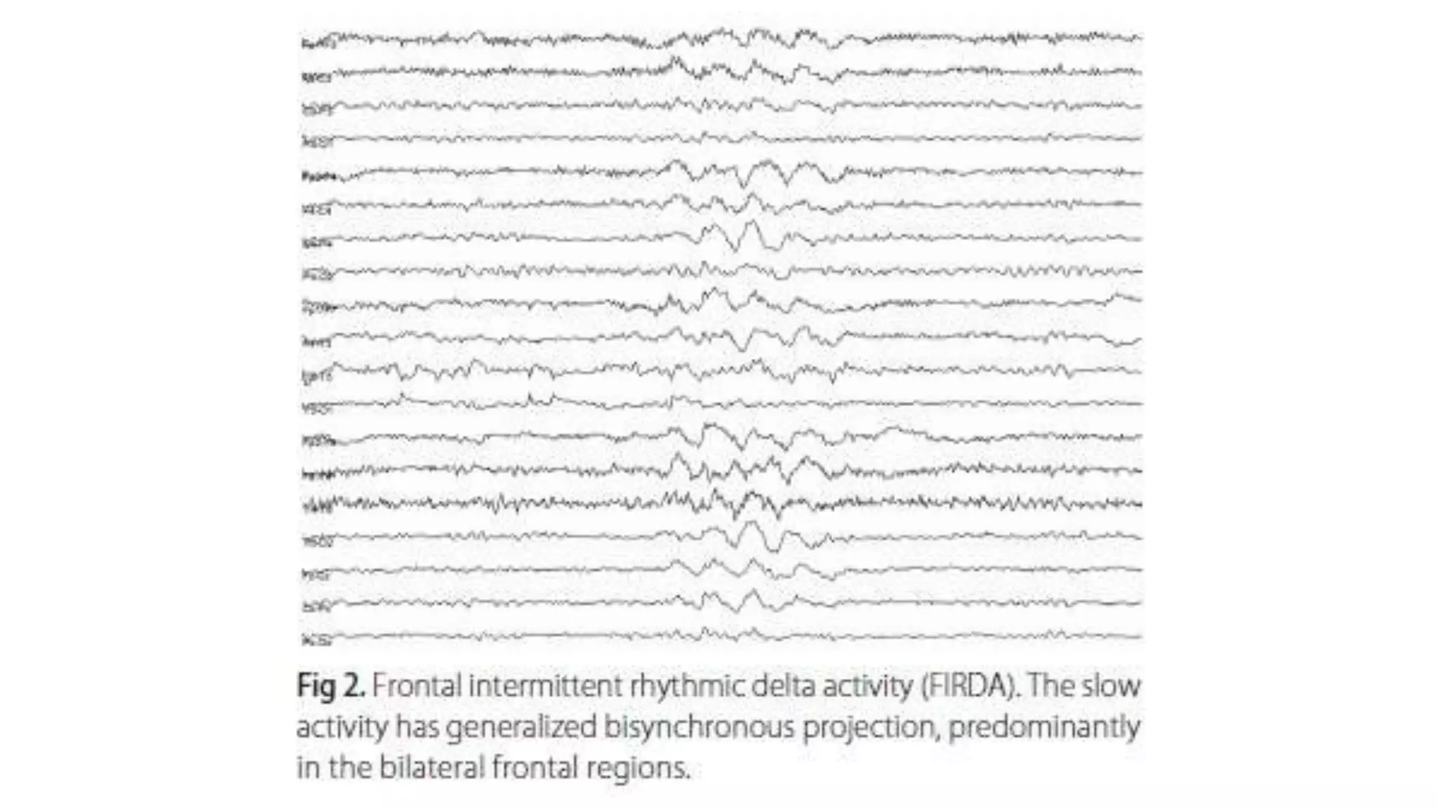 Abnormal eeg | PPTX