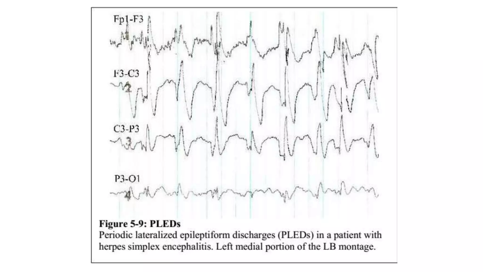Abnormal eeg | PPTX