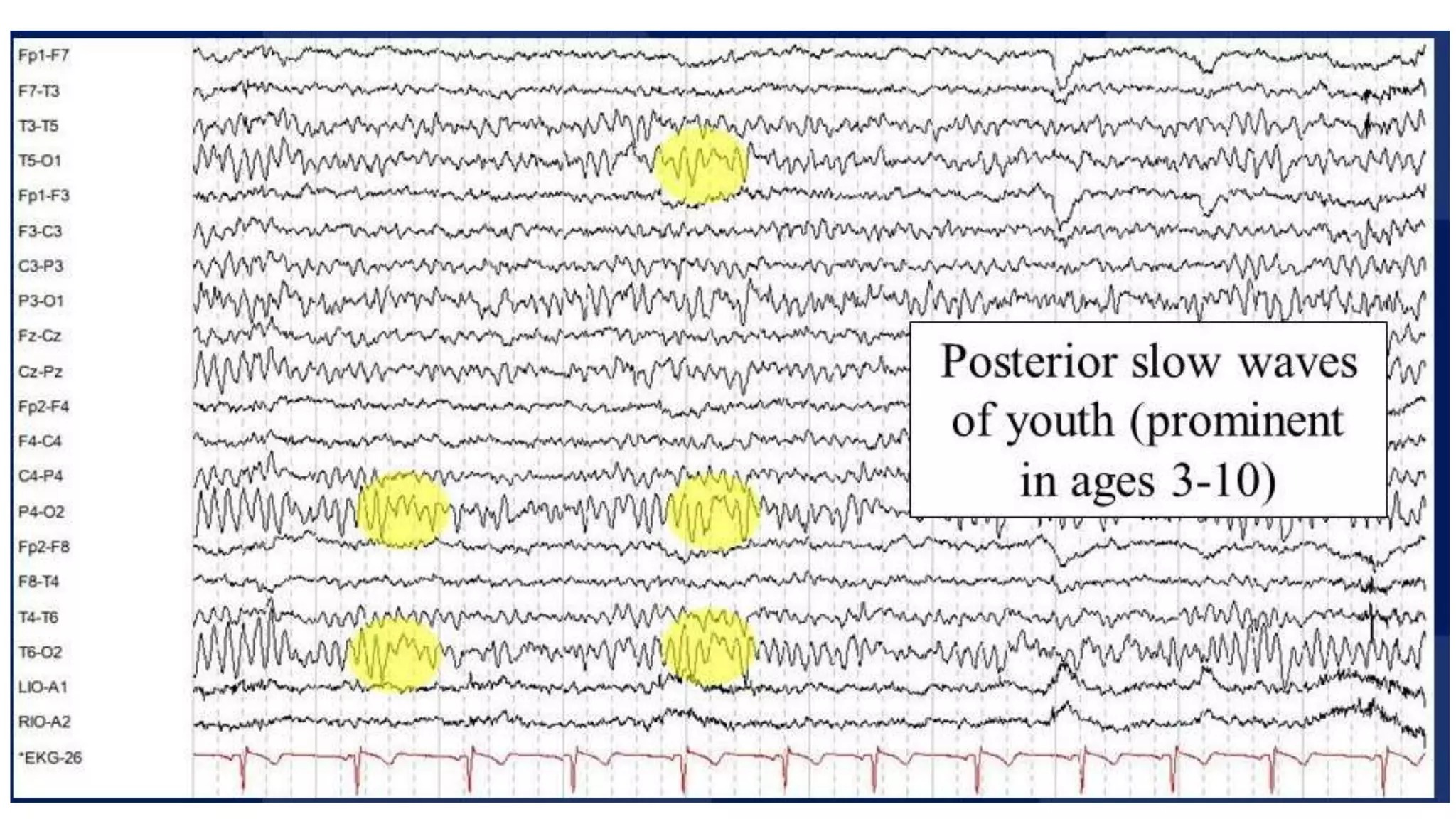 Abnormal eeg | PPTX