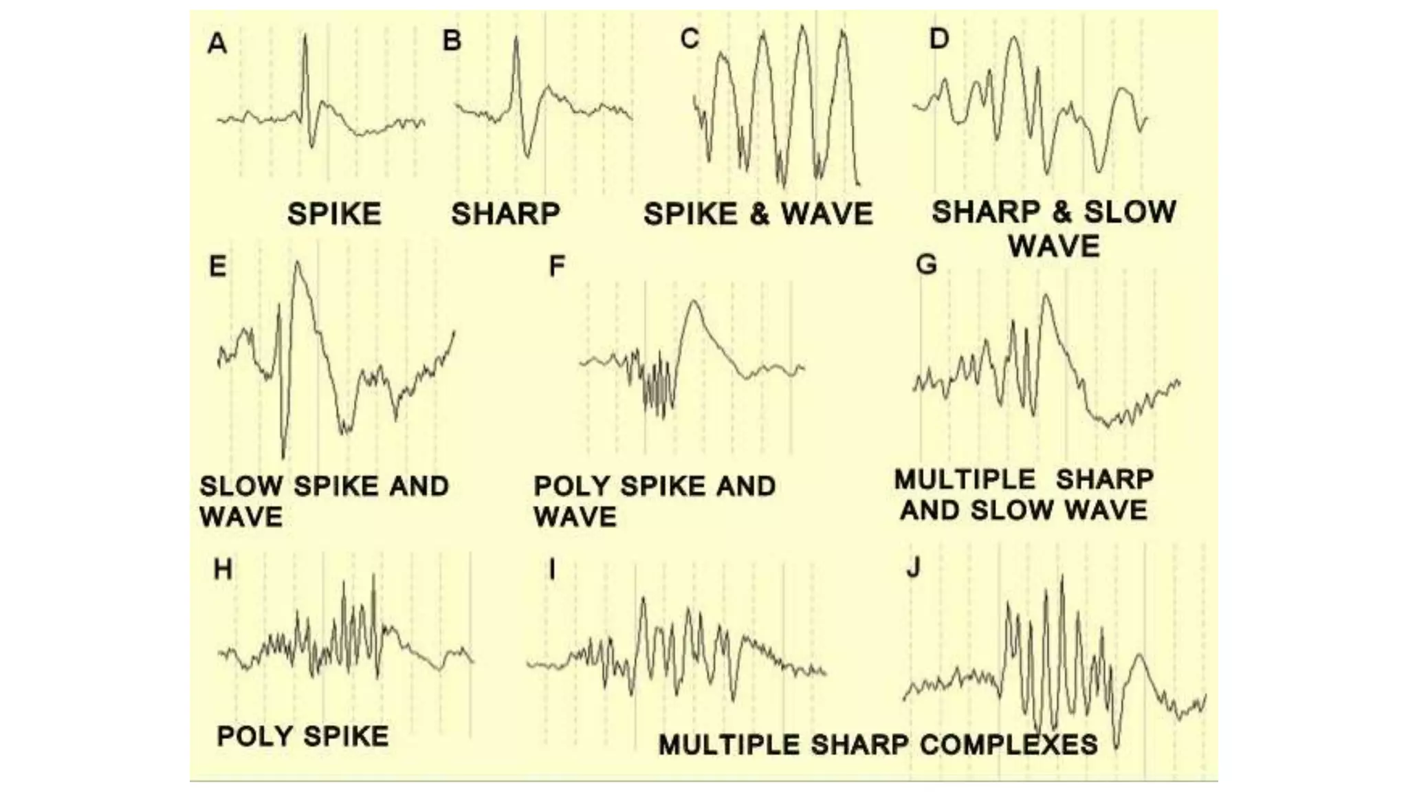 Abnormal eeg | PPTX