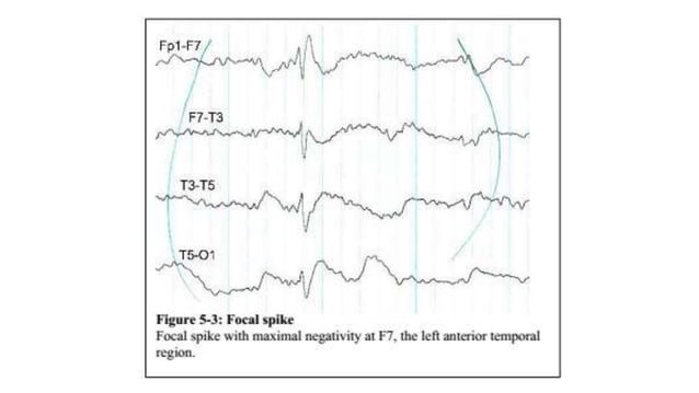 Abnormal eeg | PPTX