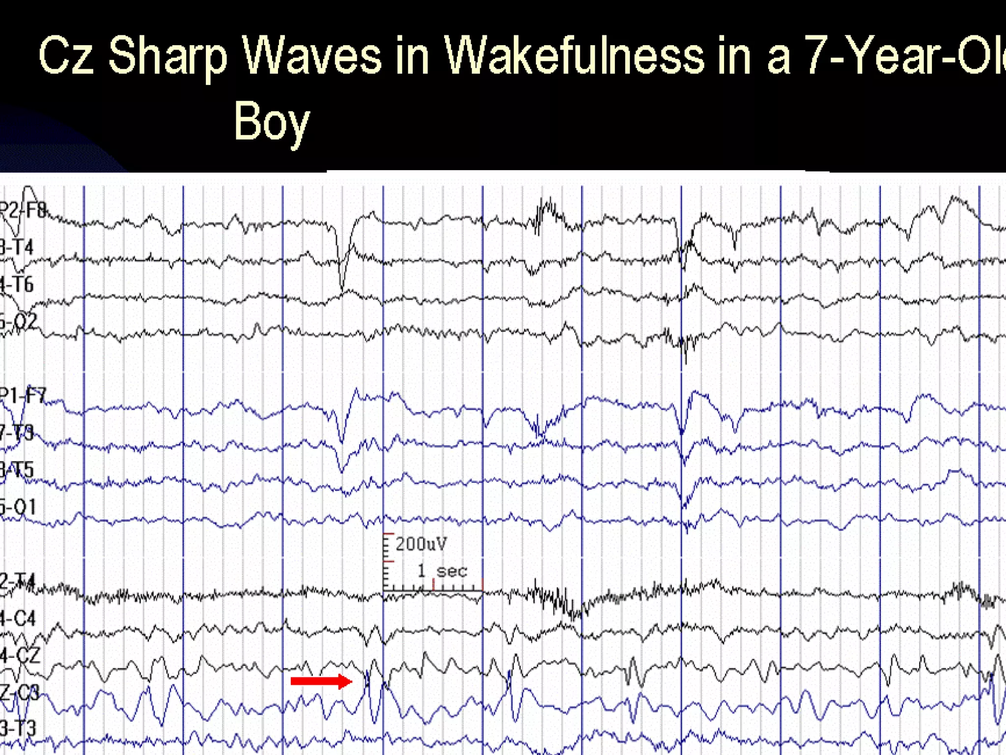 Abnormal EEG patterns | PPT