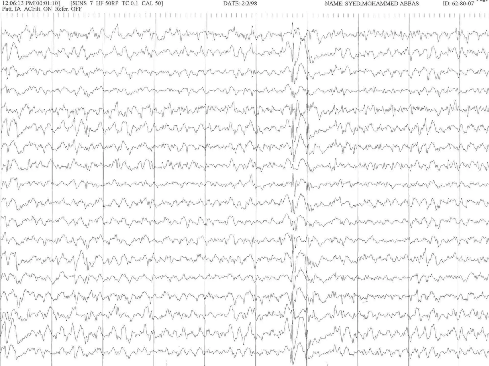 Abnormal EEG patterns | PPT