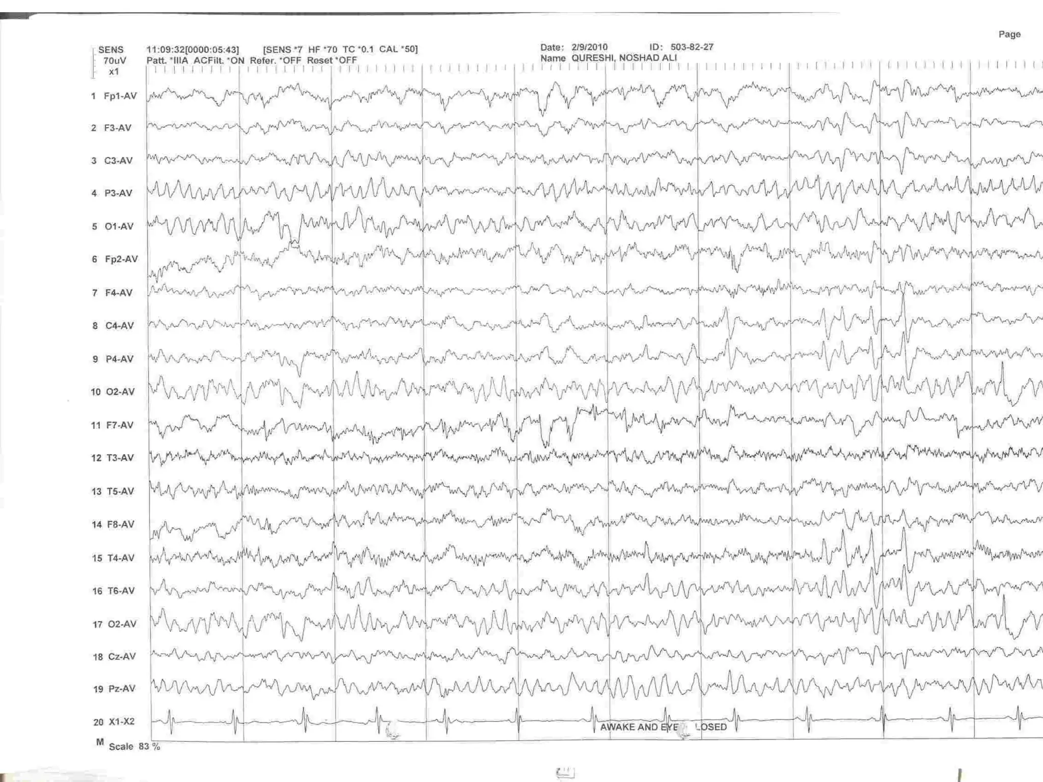 Abnormal EEG patterns | PPT