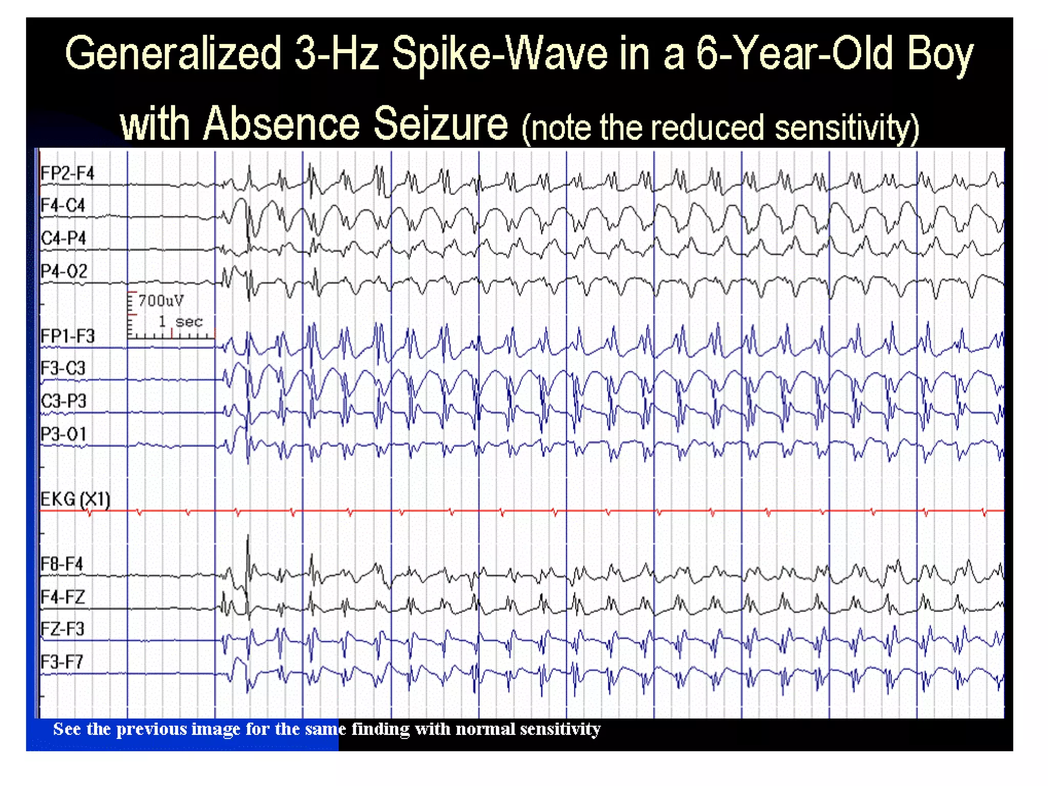 Abnormal EEG patterns | PPT