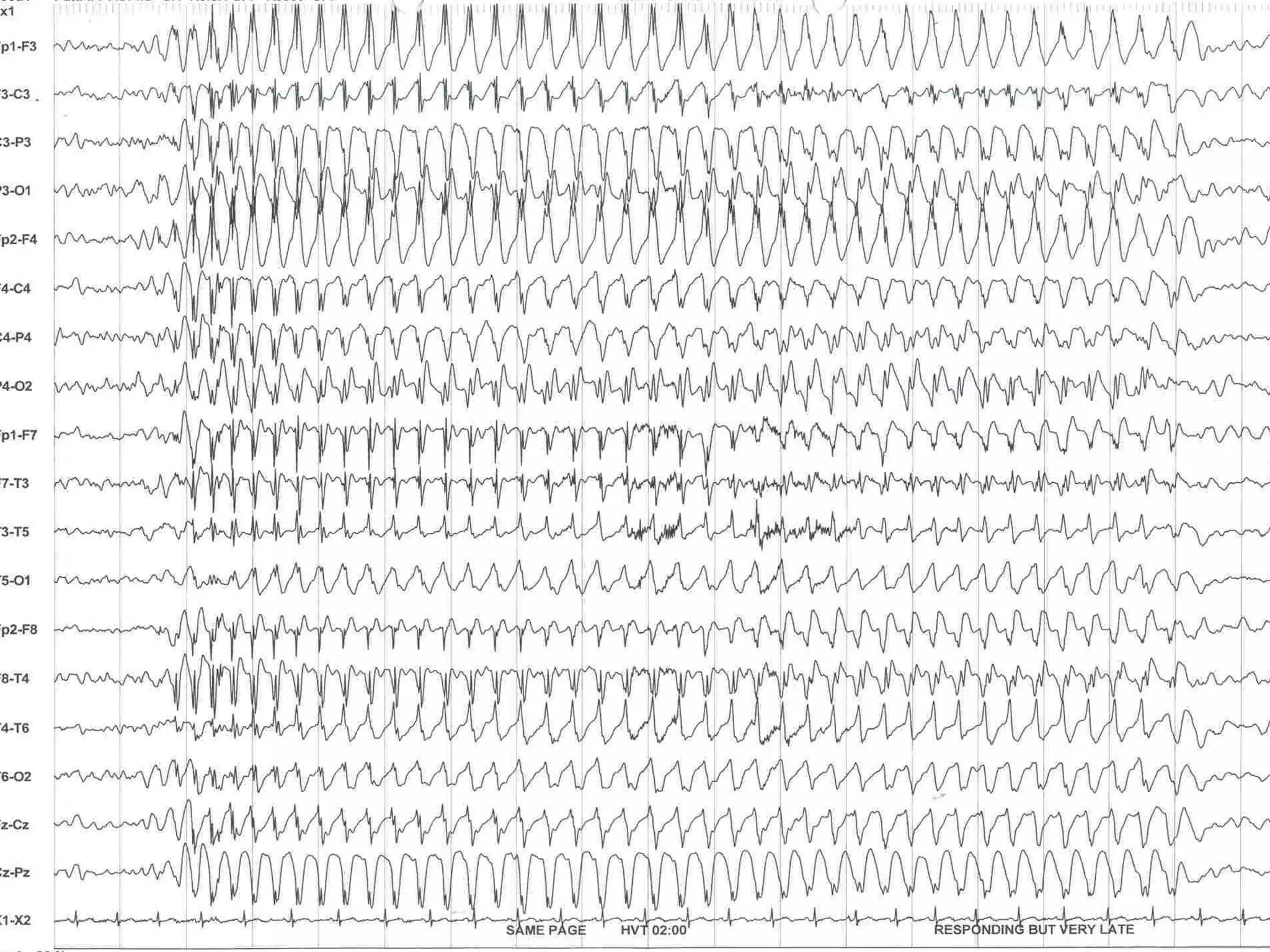 Abnormal EEG patterns | PPT