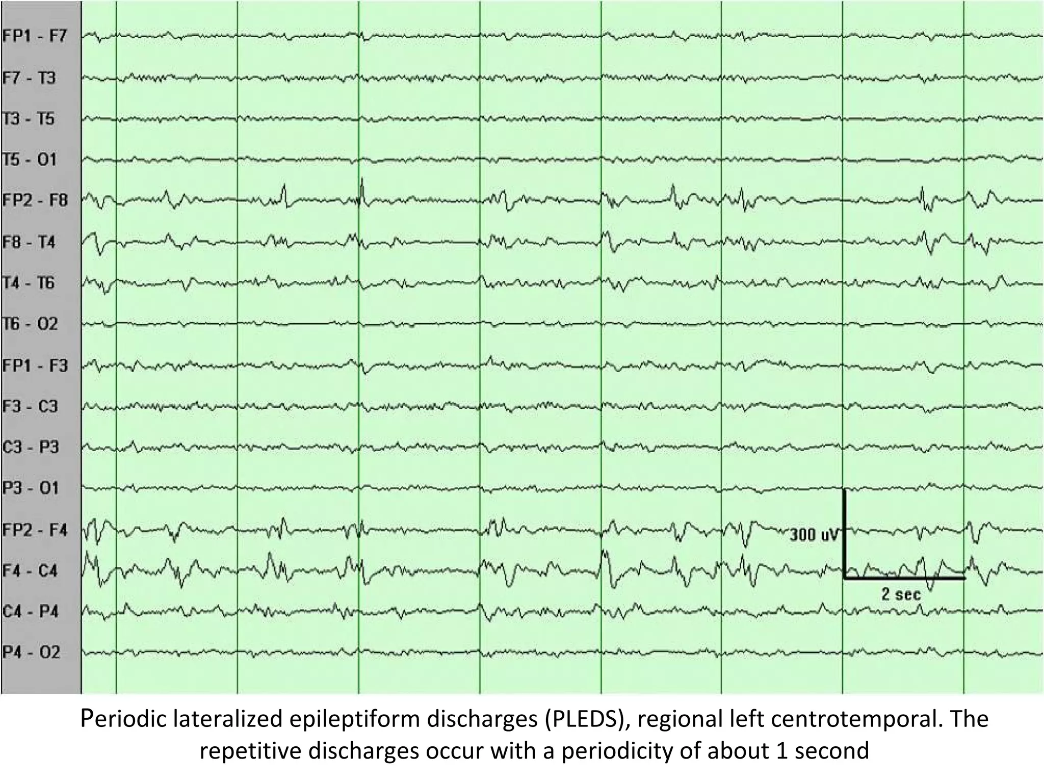 Abnormal EEG patterns | PPT
