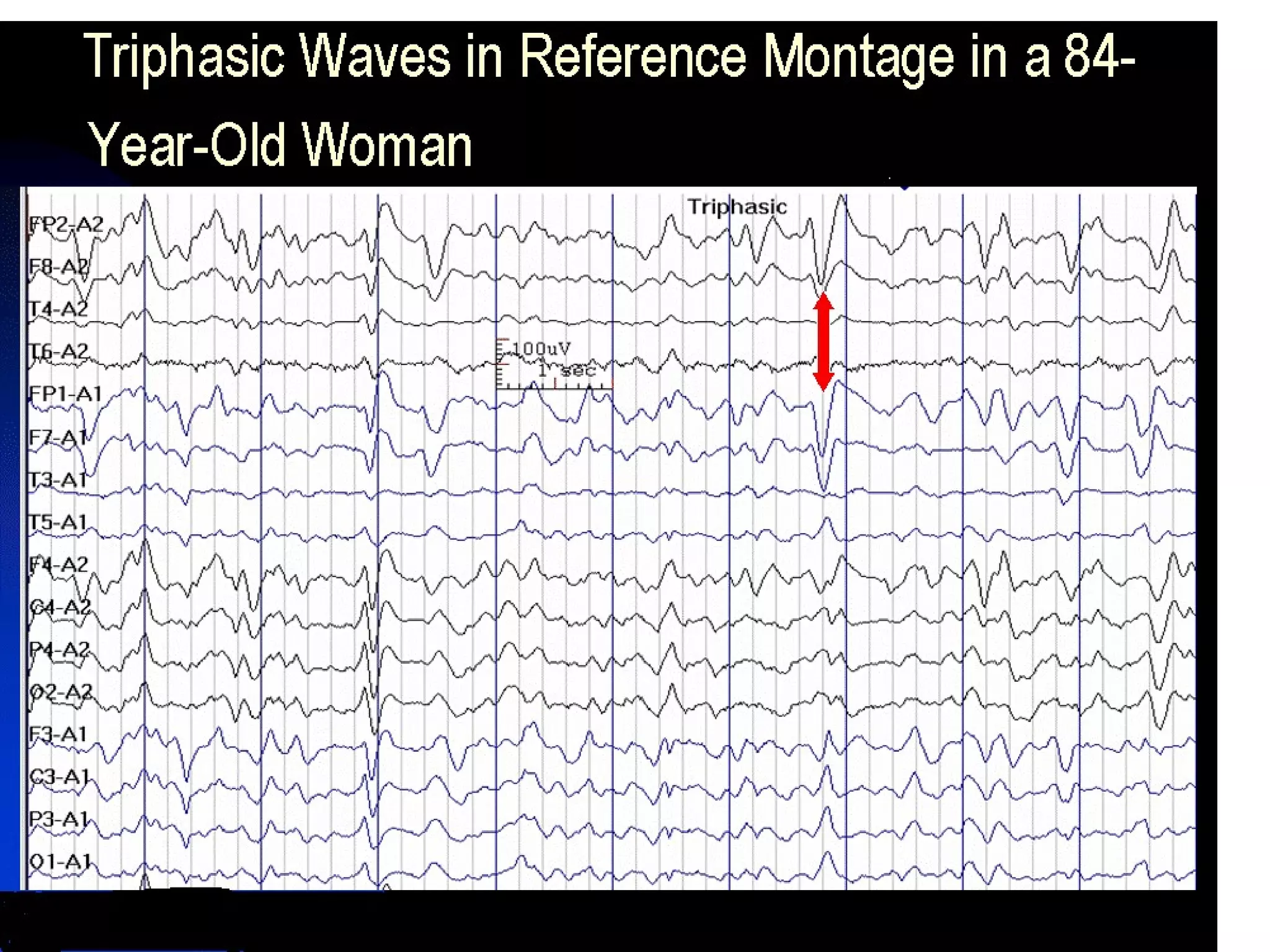 Abnormal EEG patterns | PPT