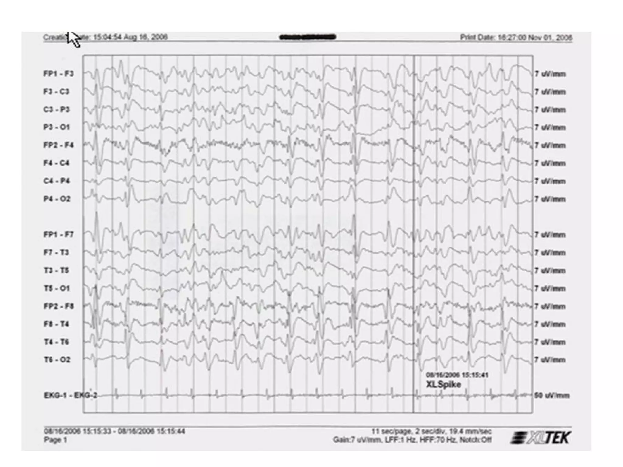 Abnormal EEG patterns | PPT