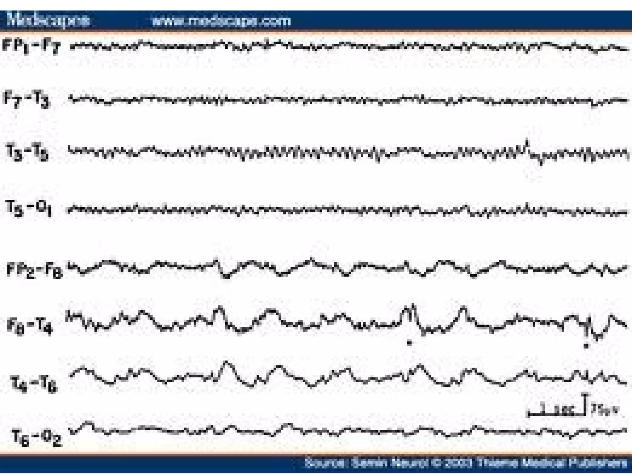 Abnormal EEG patterns | PPT