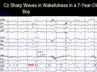 Abnormal EEG patterns | PPT
