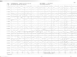 Abnormal EEG patterns | PPT