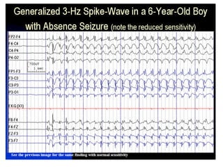 Abnormal EEG patterns | PPT