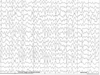 Abnormal EEG patterns | PPT
