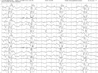 Abnormal EEG patterns | PPT