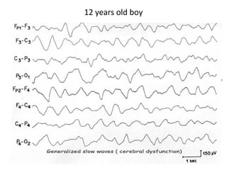 Abnormal EEG patterns | PPT
