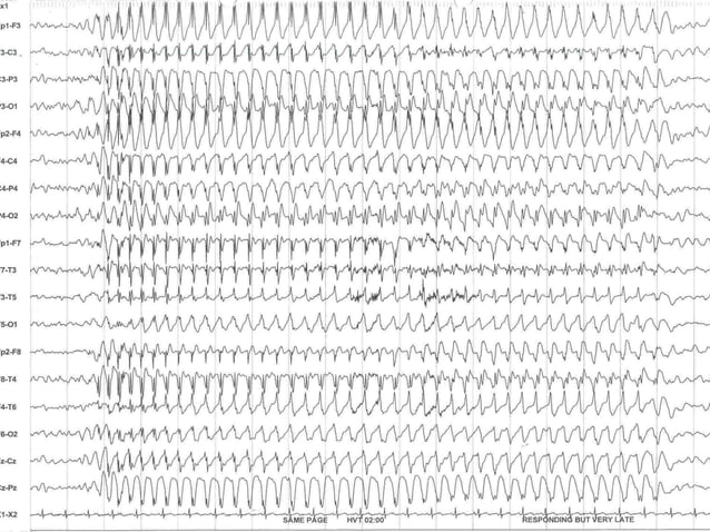 Abnormal EEG patterns | PPT