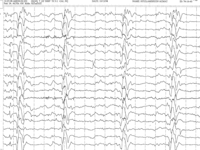 Abnormal EEG patterns | PPT