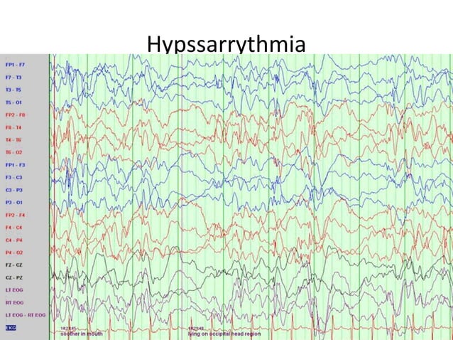 Abnormal EEG patterns | PPT