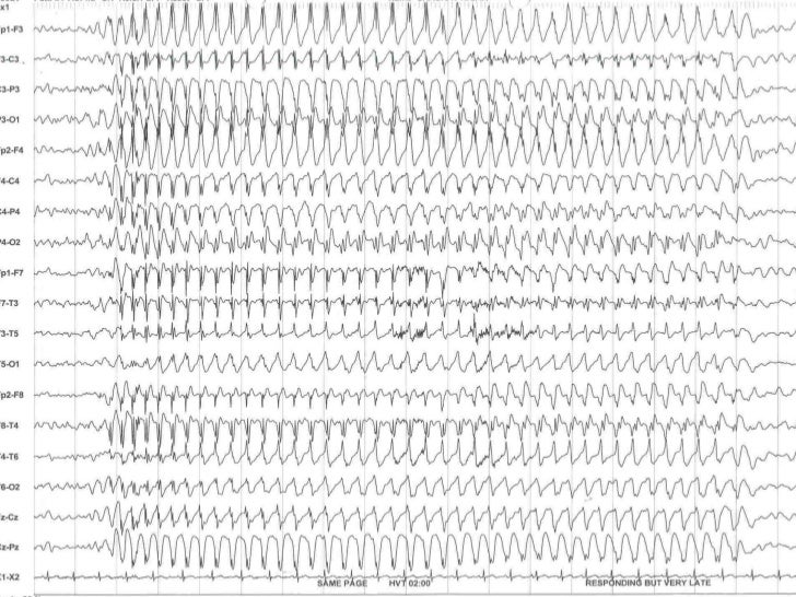 Abnormal EEG patterns