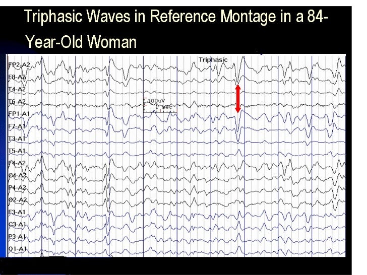 Abnormal EEG patterns