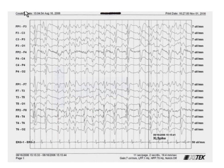 Abnormal EEG patterns