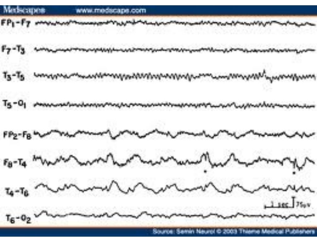 Abnormal Eeg Patterns
