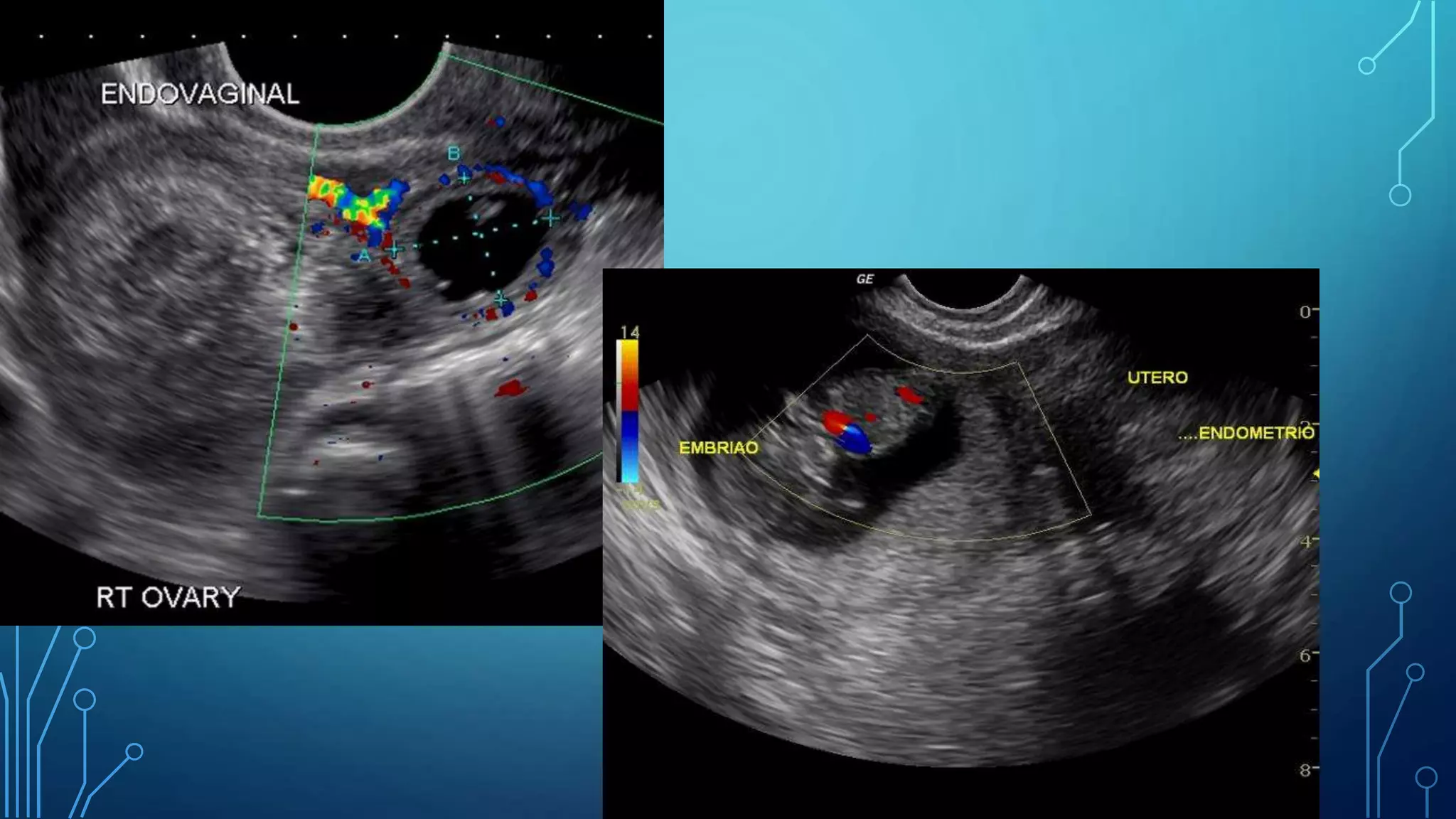 Abnormal first trimester scan | PPTX