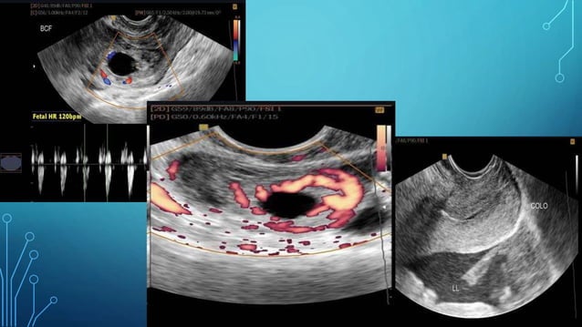 Abnormal first trimester scan | PPT