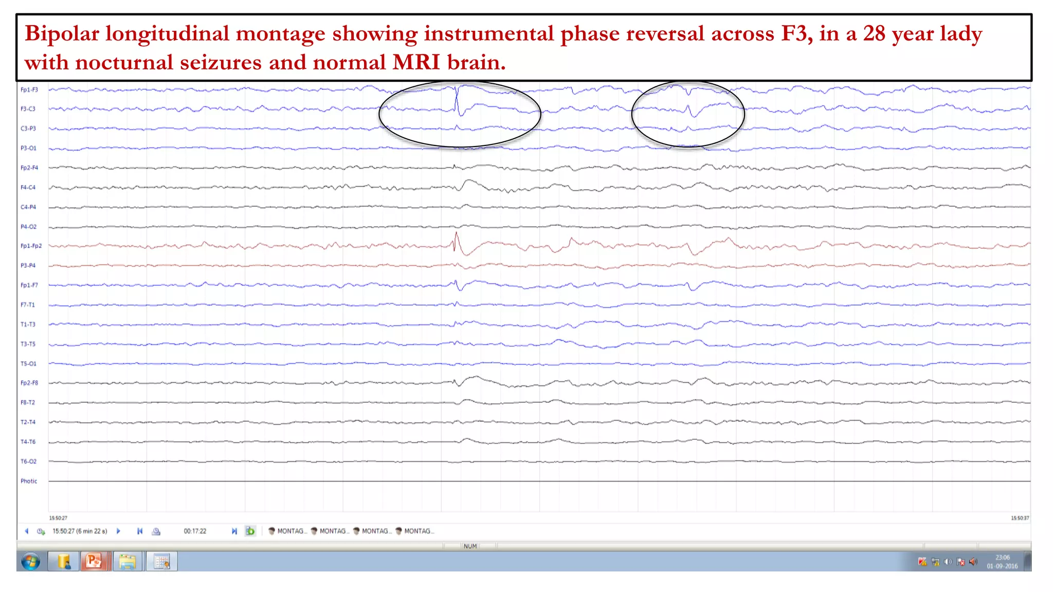 Abnormal focal eeg patterns | PPTX