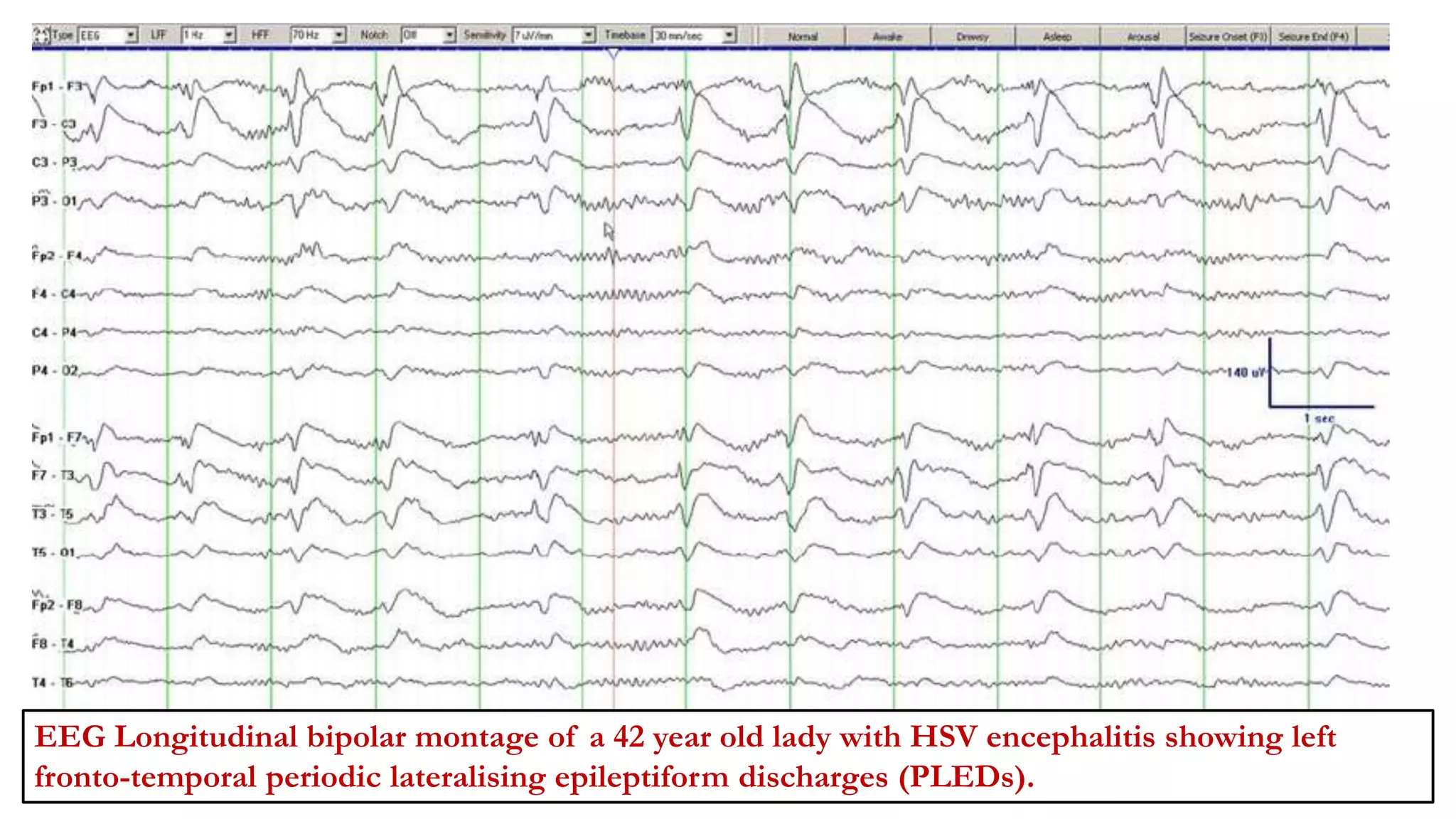 Abnormal focal eeg patterns | PPTX