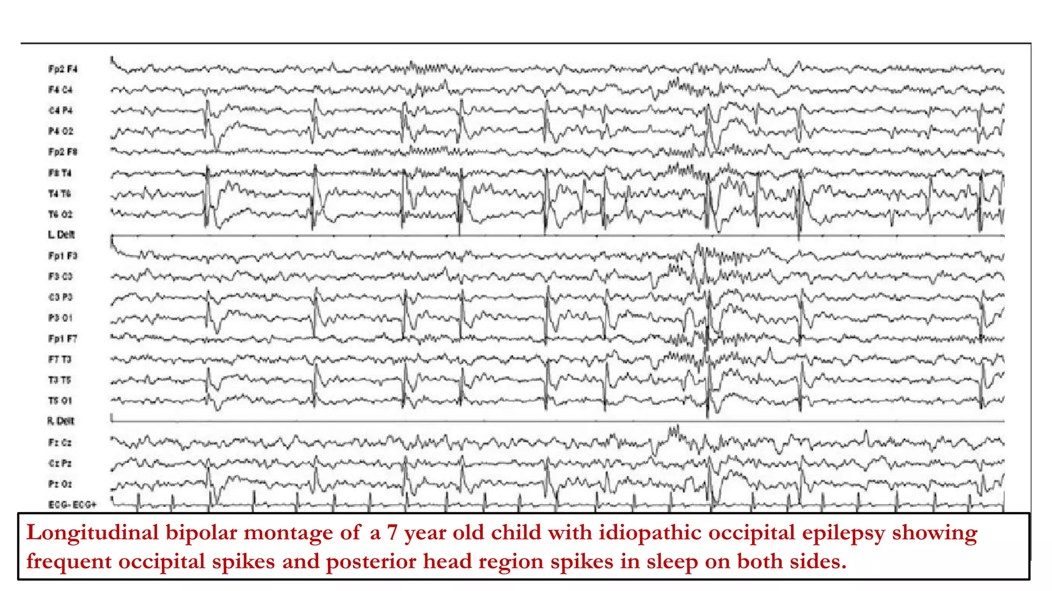Abnormal focal eeg patterns | PPTX
