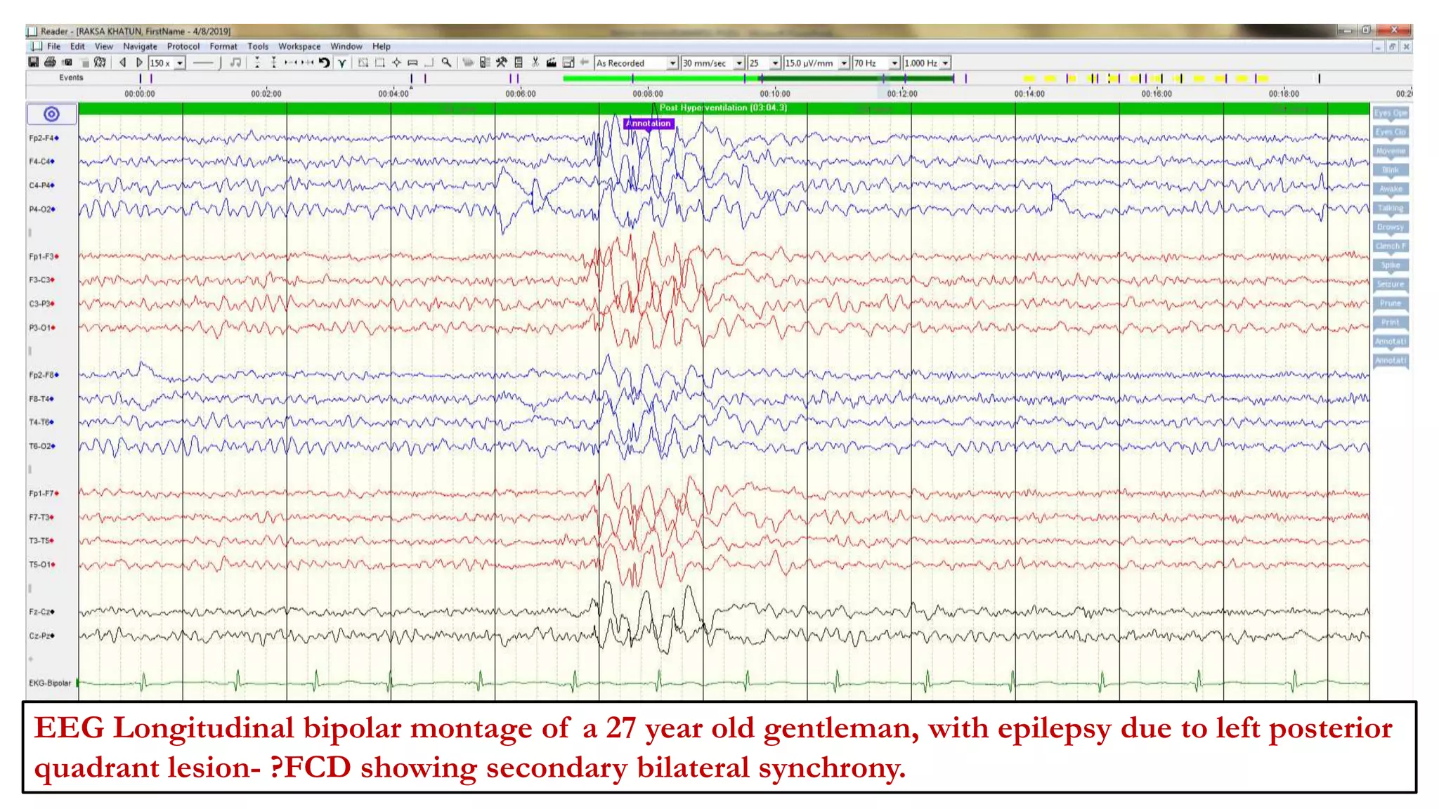 Abnormal focal eeg patterns | PPTX