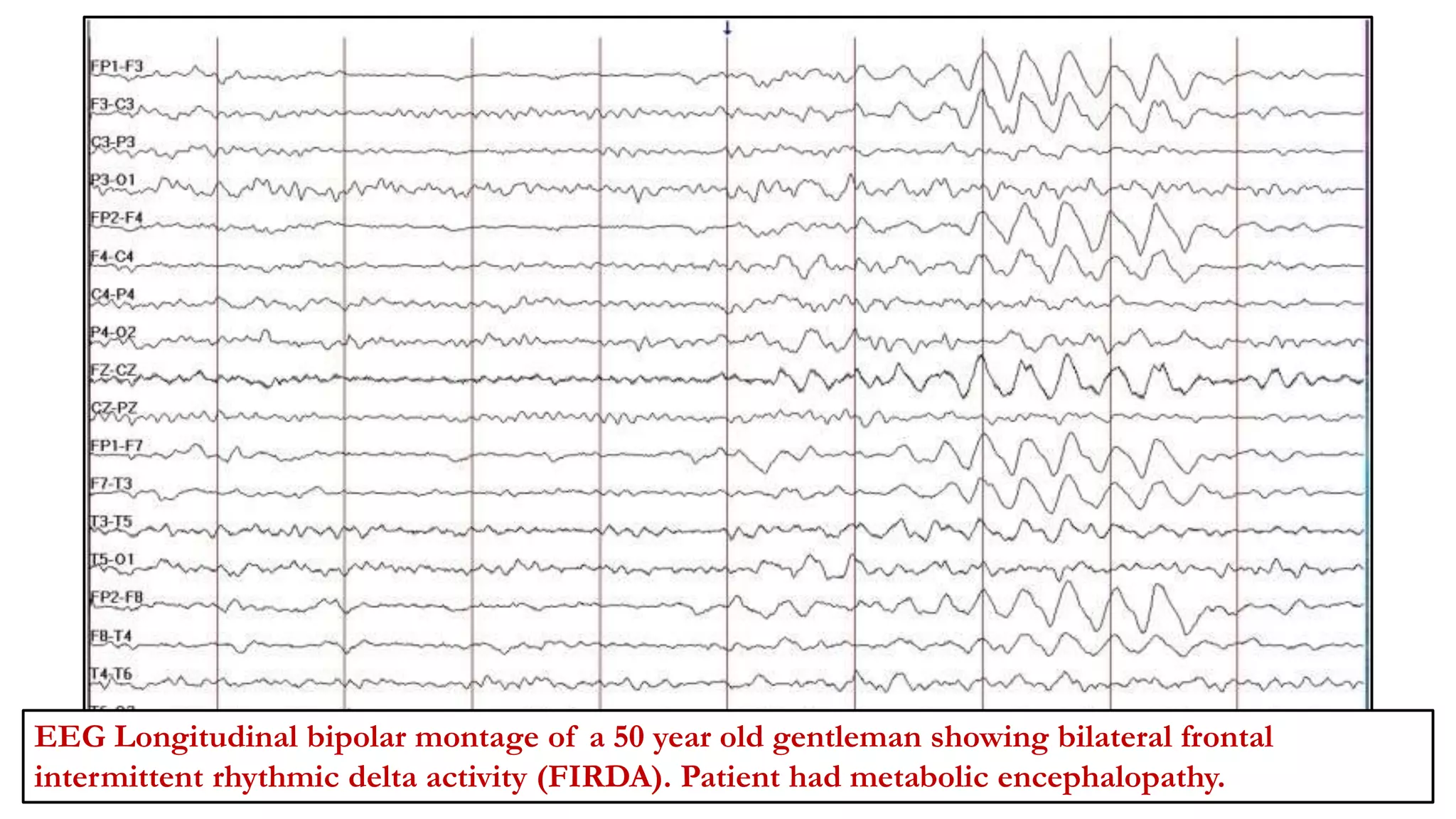 Abnormal focal eeg patterns | PPTX
