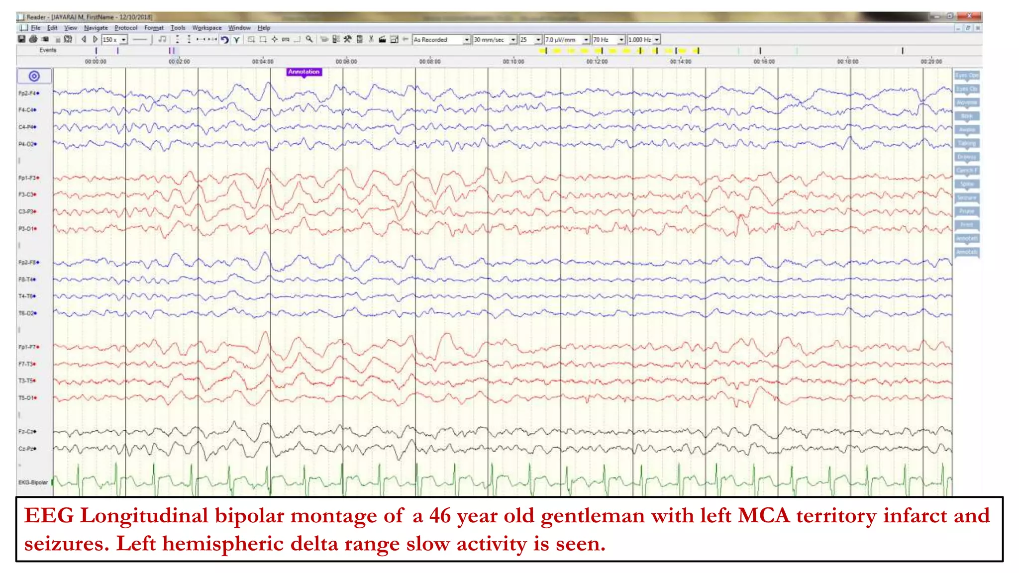 Abnormal focal eeg patterns | PPTX