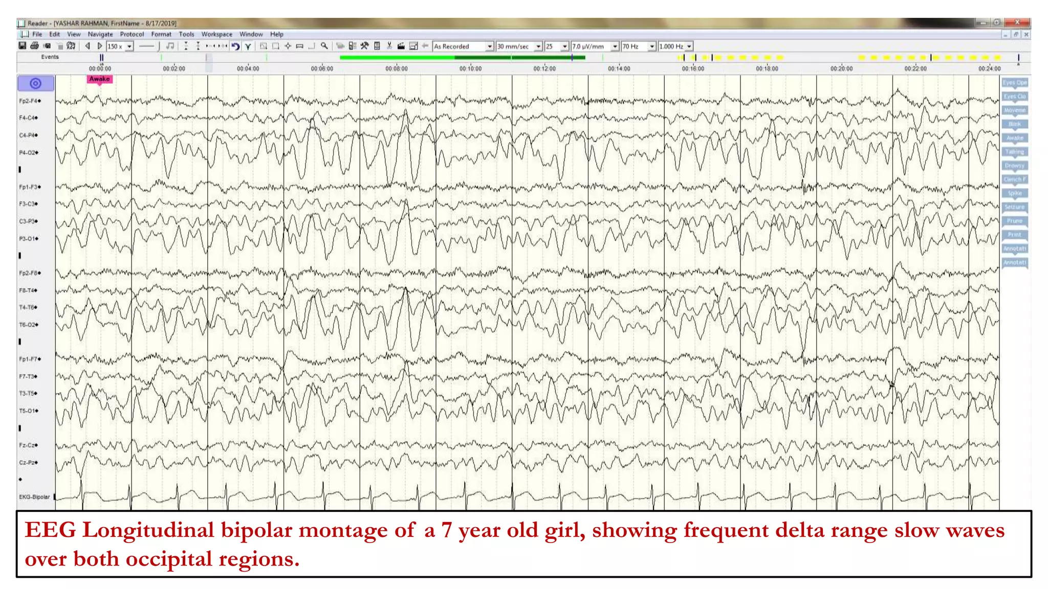 Abnormal focal eeg patterns | PPTX