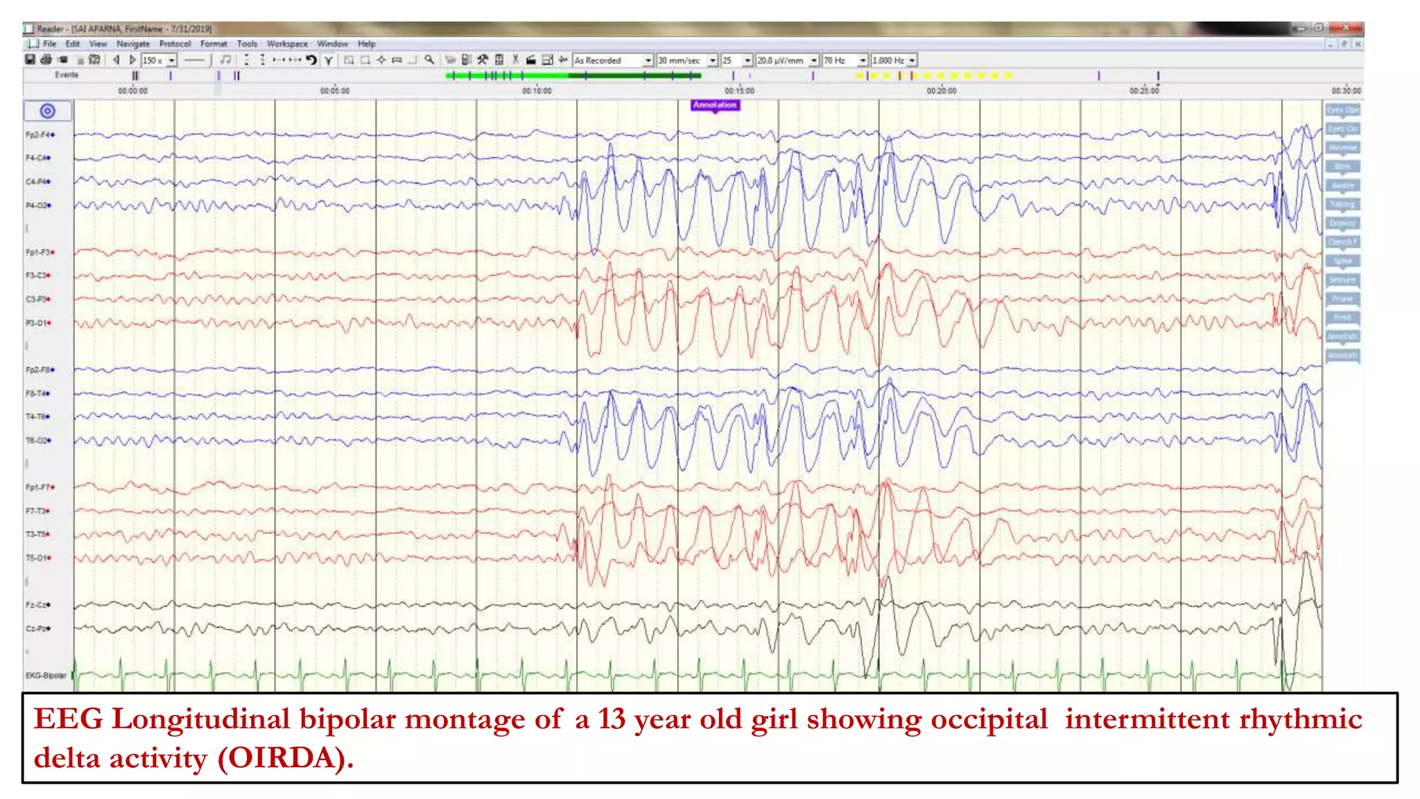Abnormal focal eeg patterns | PPTX