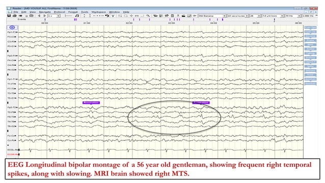 Abnormal focal eeg patterns | PPTX